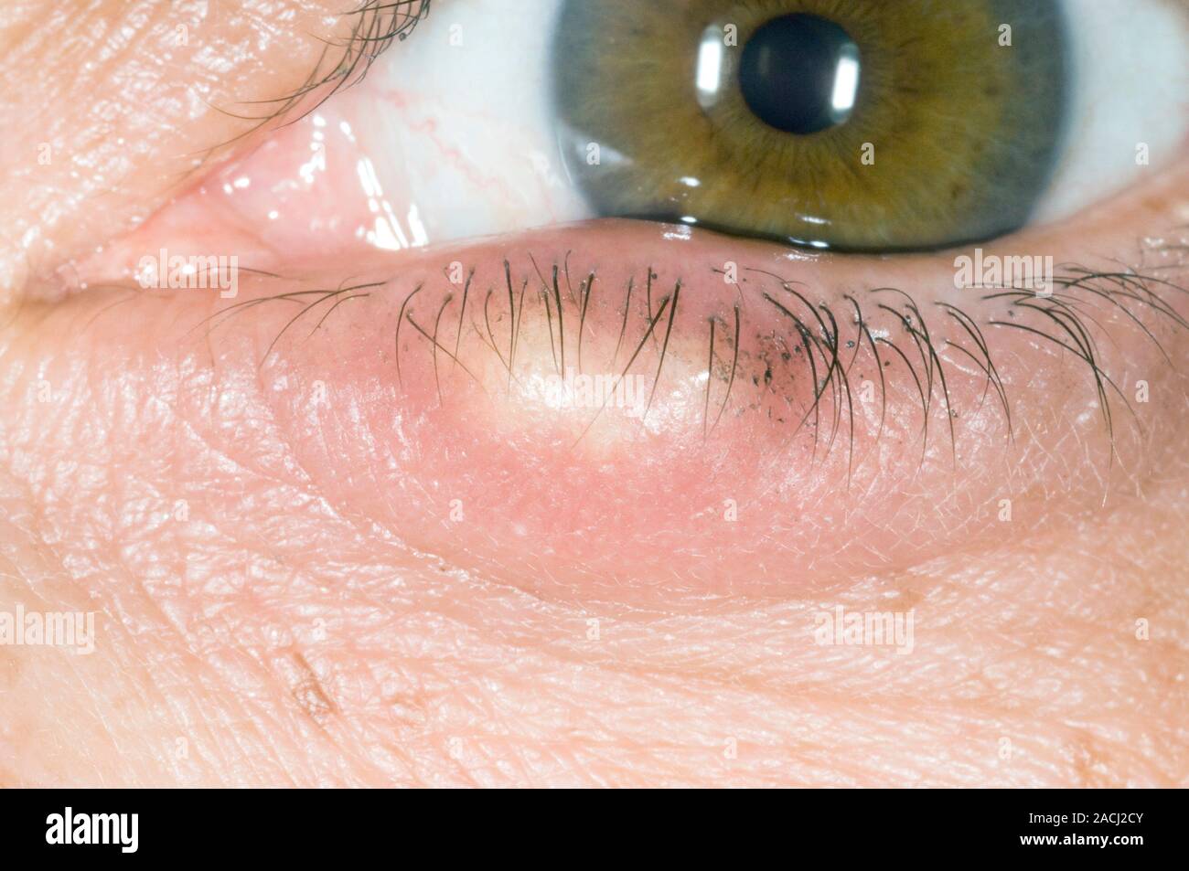Close-up of a stye (hordeolum) on the lower eyelid in a 47 year old ...