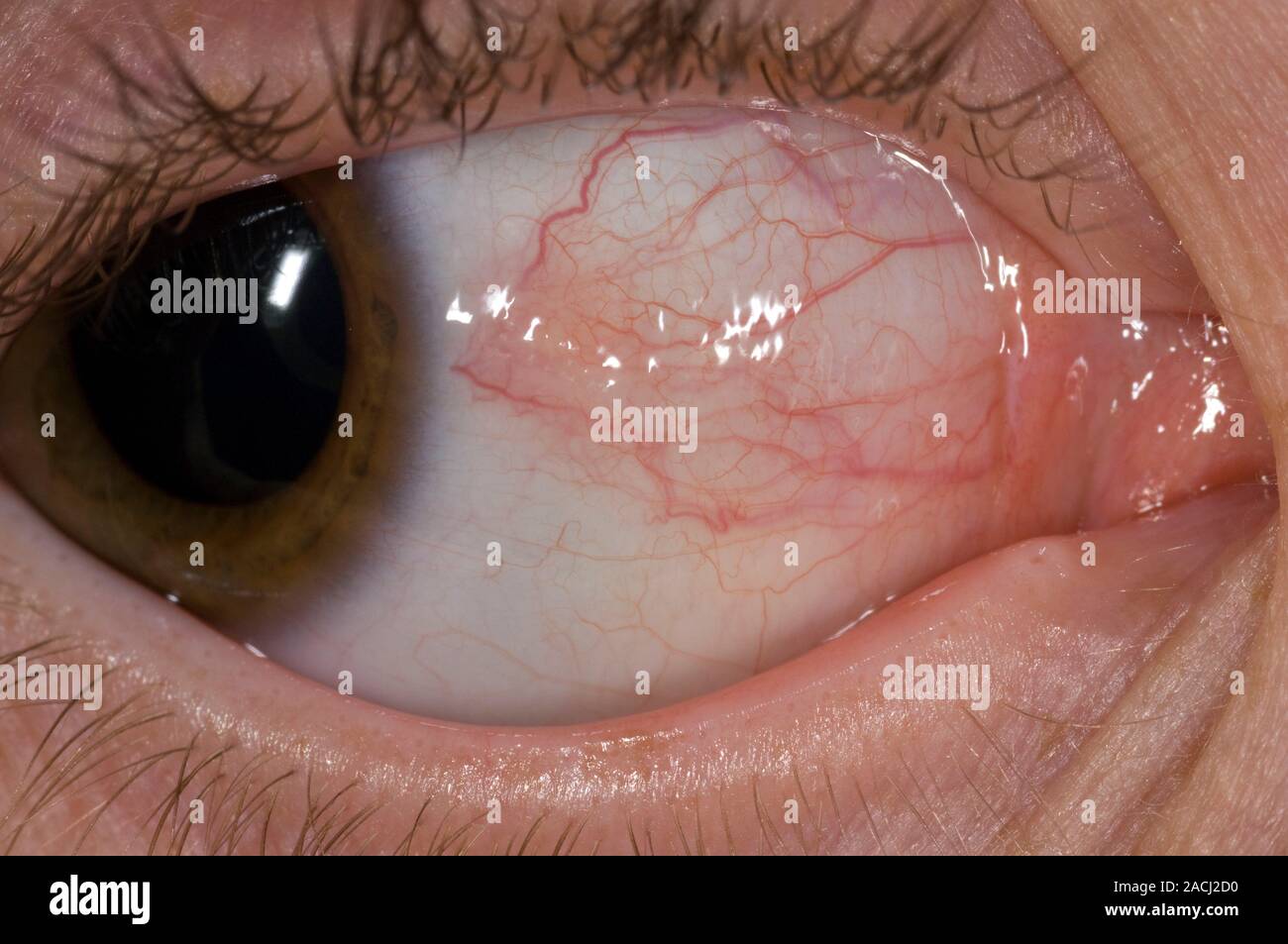Sclera Inflammation SCLERITIS
