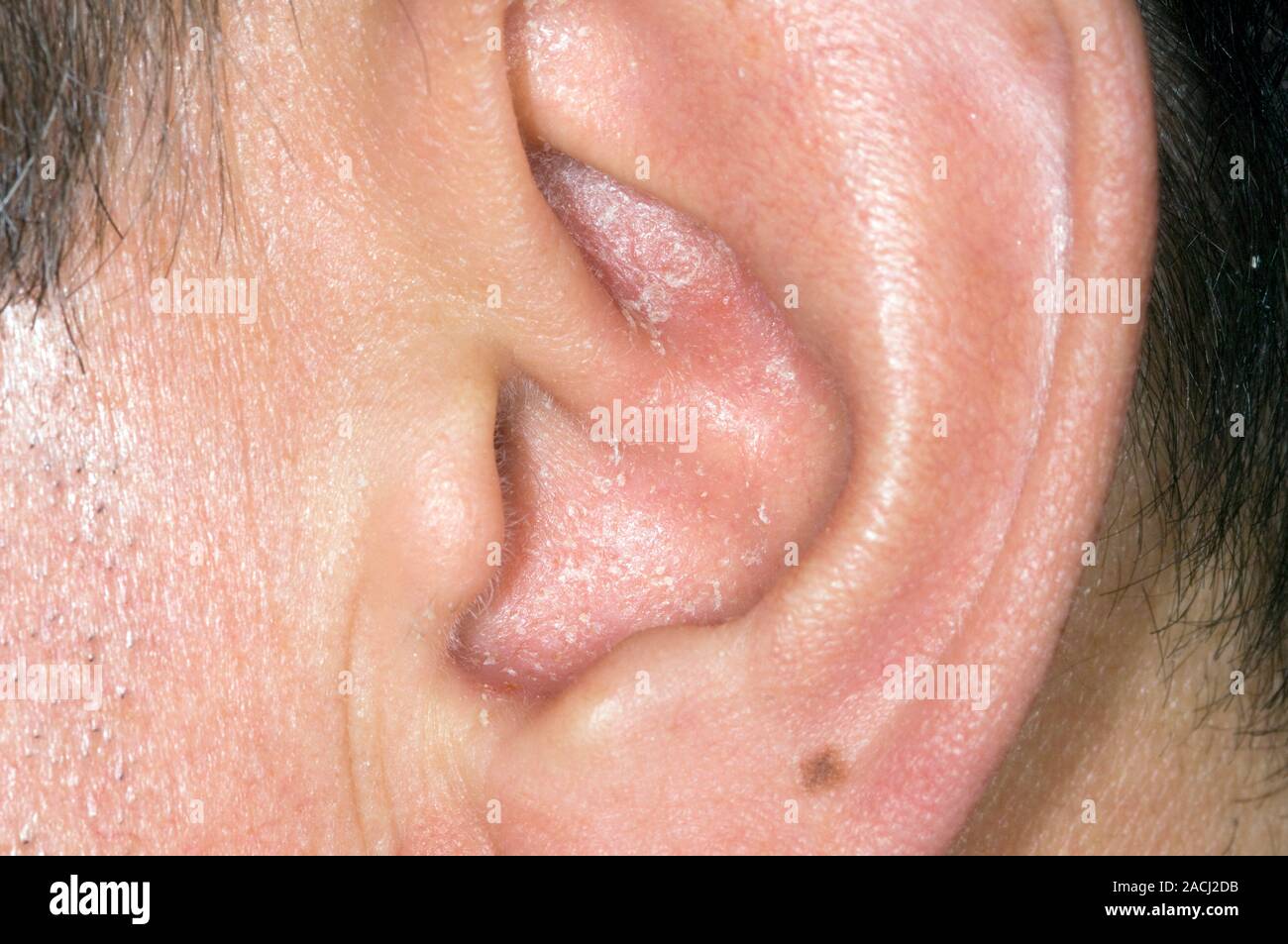 Flaking and scaling skin in the ear in a 57 year old male patient due ...