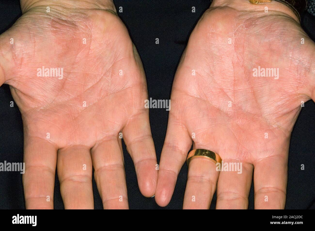 Flaking and scaling skin on the palm of the hands in a 57 year old male patient due to psoriasis ...