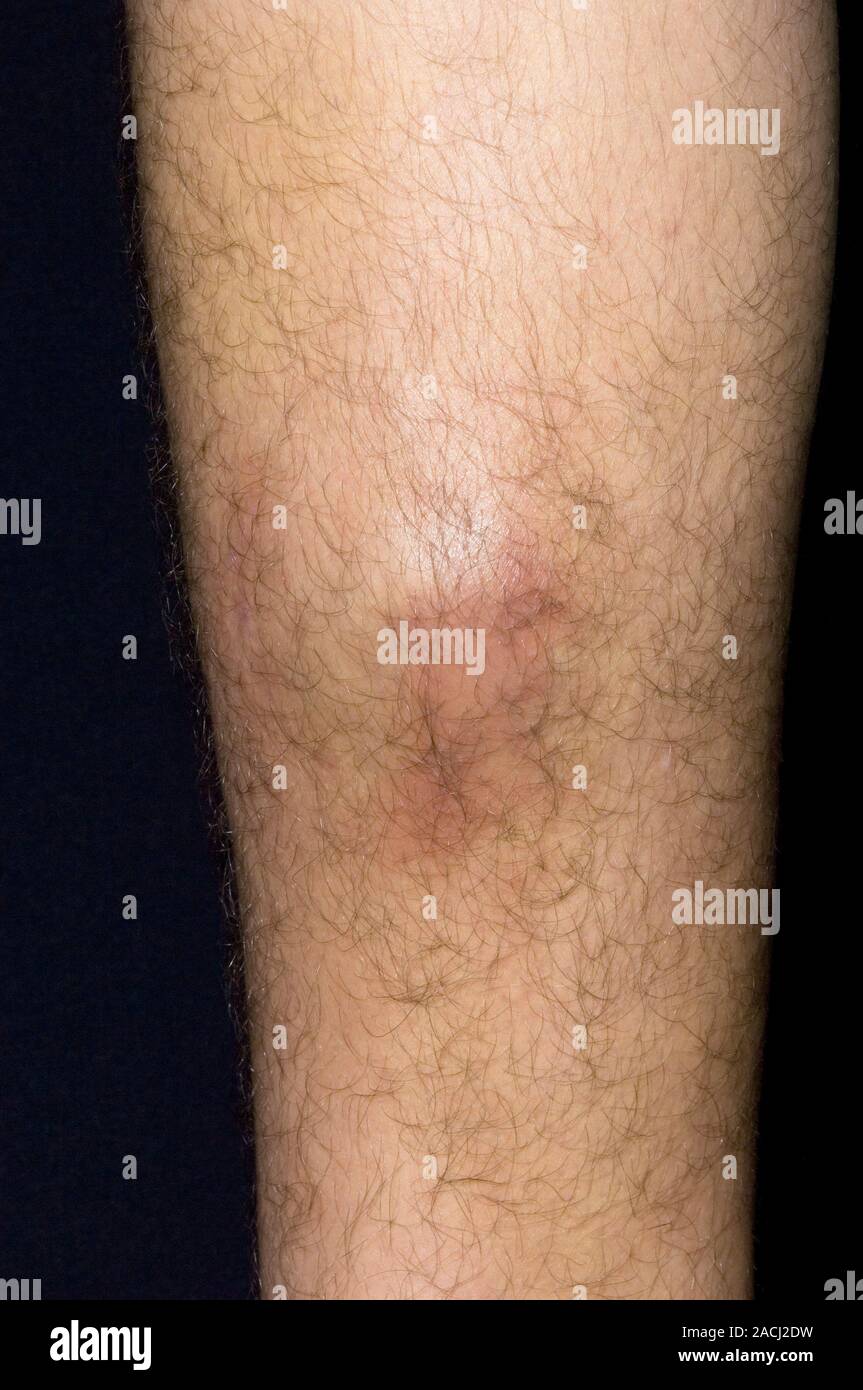 Bruise (haematoma) on the calf of the leg in a 15 year old male patient ...