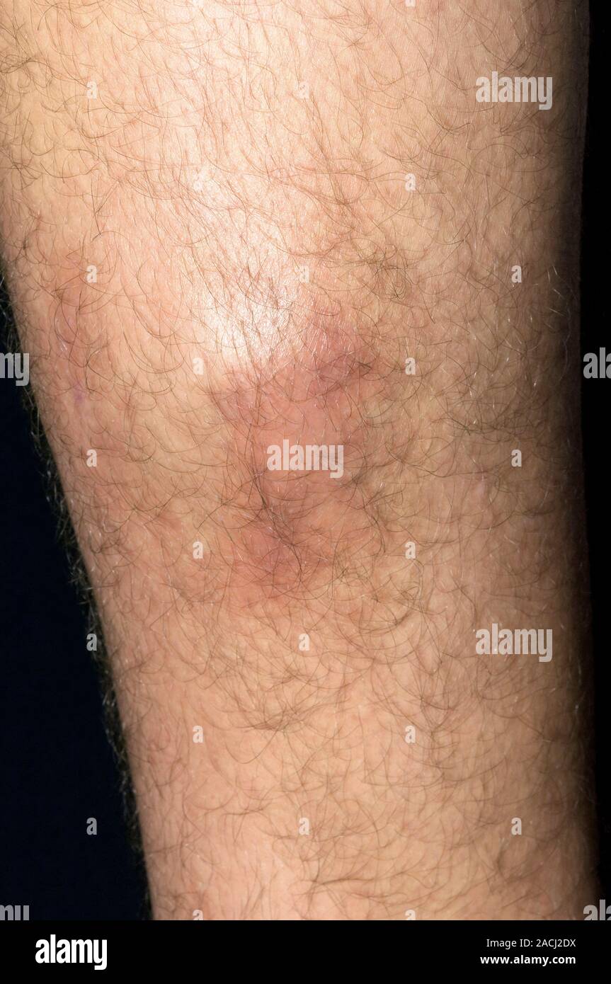 Bruise (haematoma) on the calf of the leg in a 15 year old male patient ...