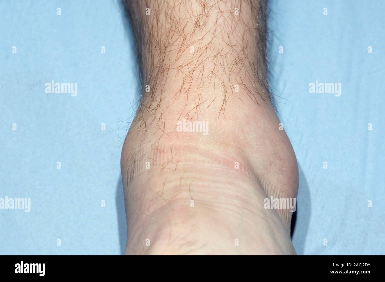 Swollen ankle in a 25 year old male patient who has sprained it ...