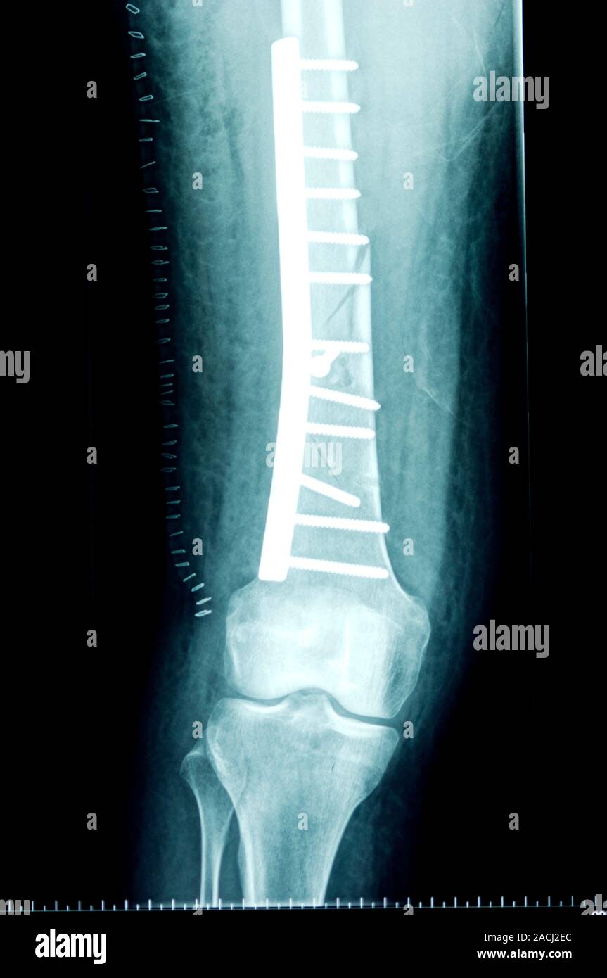 X-ray (front view) showing a row of metal pins fixing a plate to the ...
