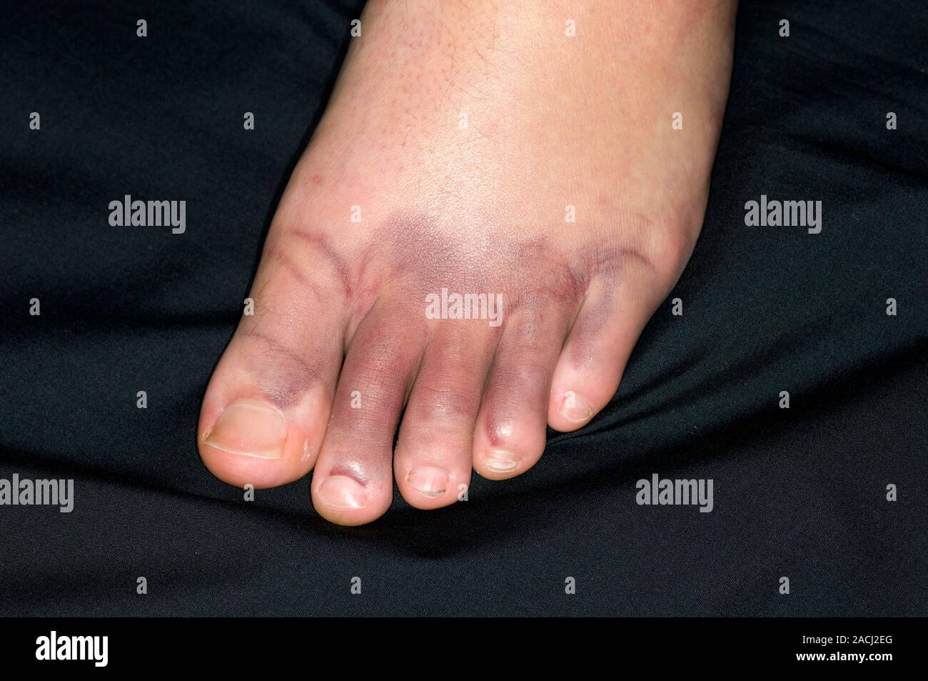 Bruising around the foot in a 27 year old male patient following soft ...