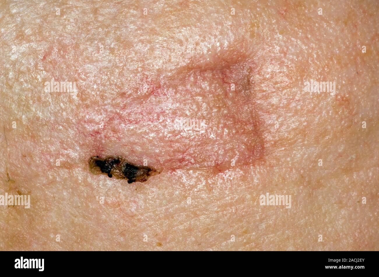Close-up of a scar on the skin in a 75 year old male patient, 1 month ...