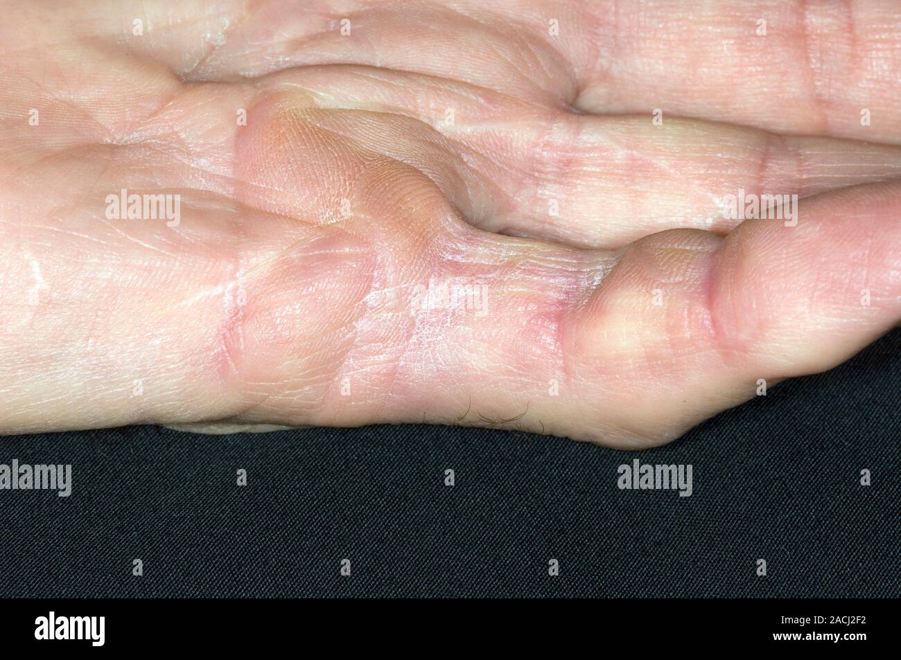 Bending of the little finger in a 71 year old male patient after ...