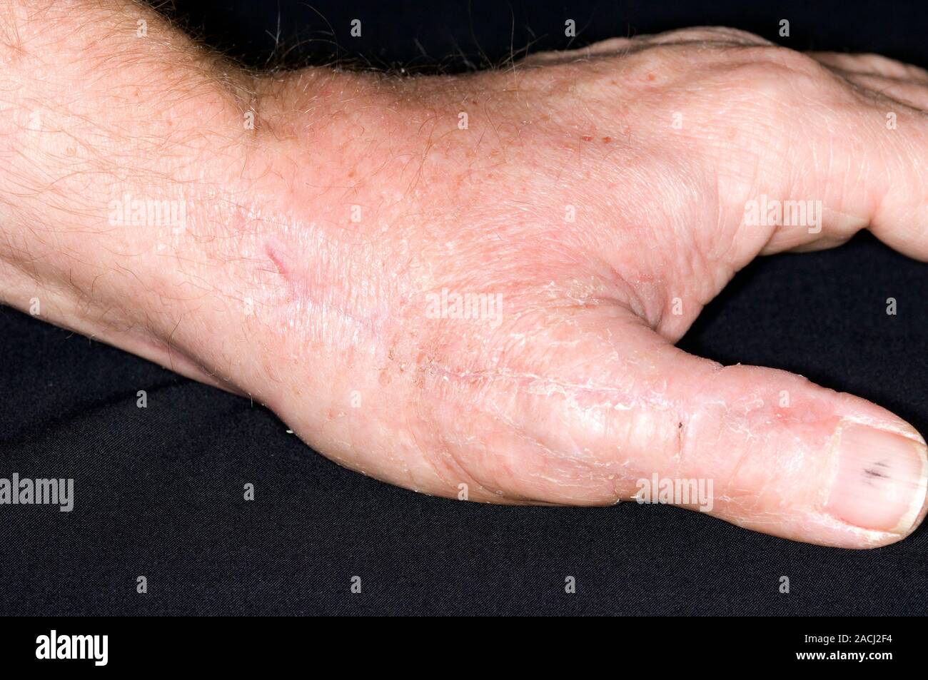 Close-up of the scarred thumb in a 53 year old male patient, 6 weeks ...
