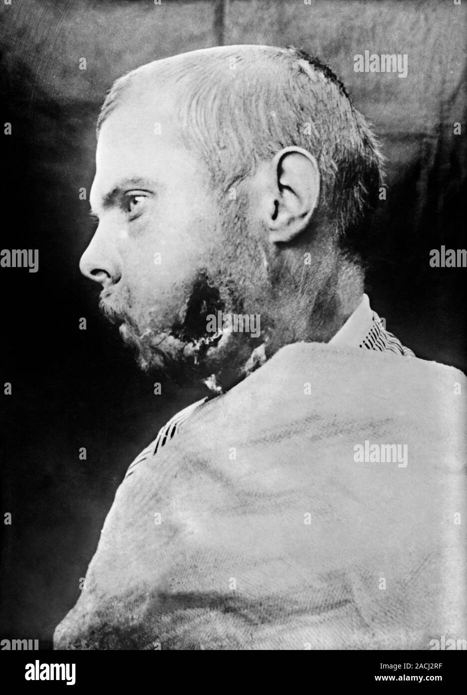 Dum-dum wound. Historical image showing the damage caused to a person who has been shot in the ...