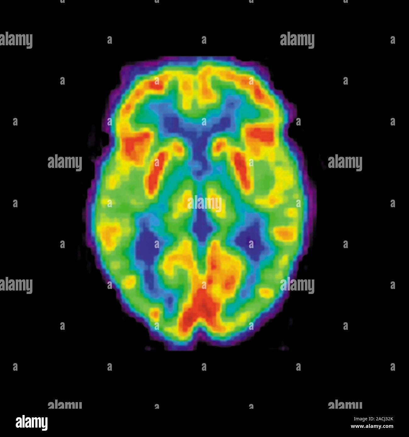PET scan of a normal and healthy 80 year old's brain Stock Photo - Alamy