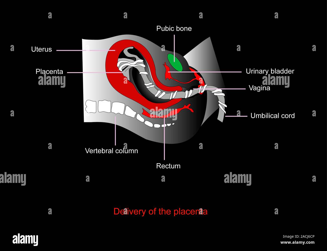 Placental expulsion, artwork. This is the third stage of labour, which ...