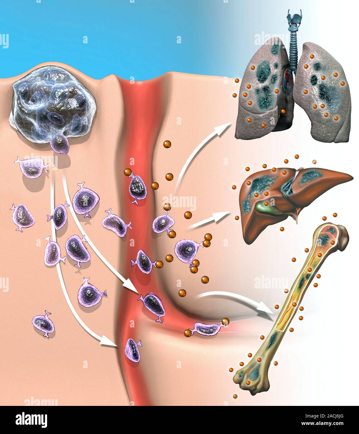 Primary and secondary cancers. Artwork showing the spread of cancer ...