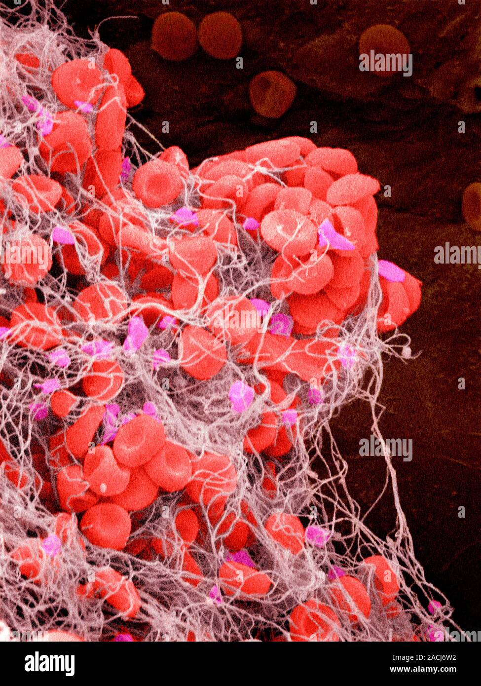 Blood clot. Coloured scanning electron micrograph (SEM) of a blood clot ...