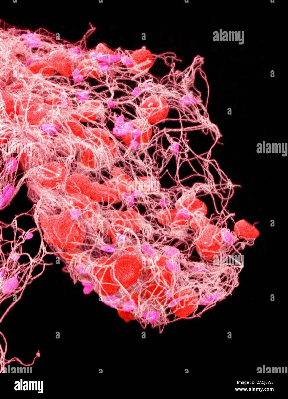 Blood clot. Coloured scanning electron micrograph (SEM) of a blood clot ...