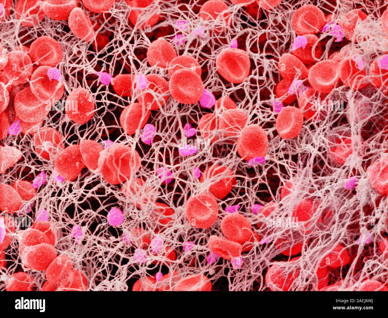 Blood clot. Coloured scanning electron micrograph (SEM) of a blood clot ...