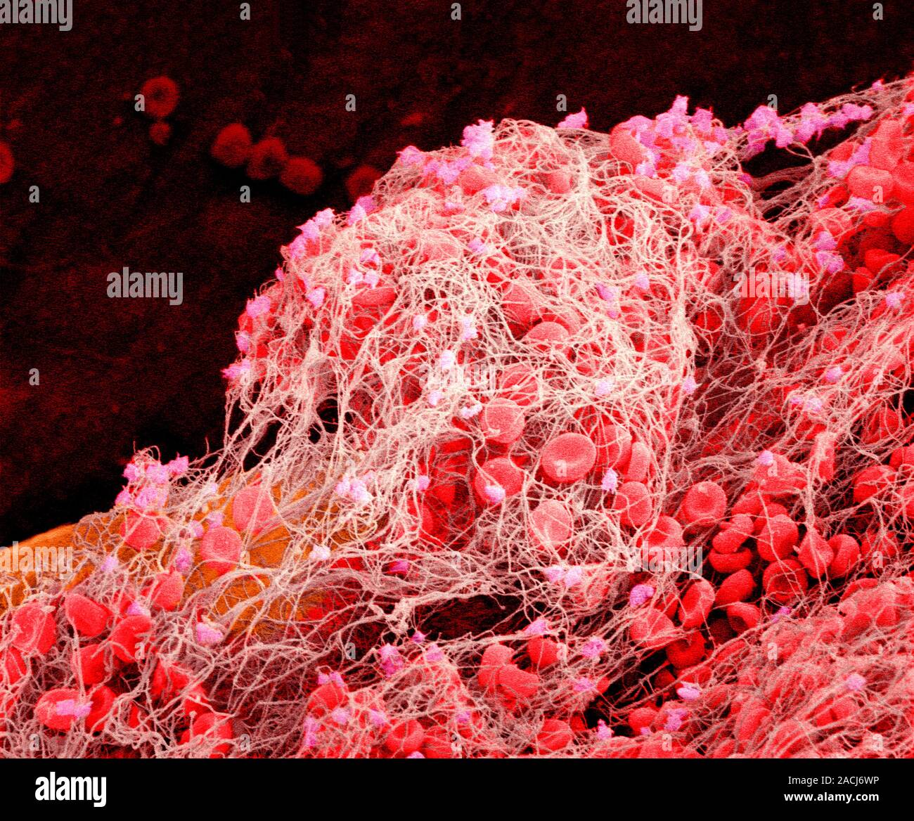 Blood clot. Coloured scanning electron micrograph (SEM) of a blood clot ...