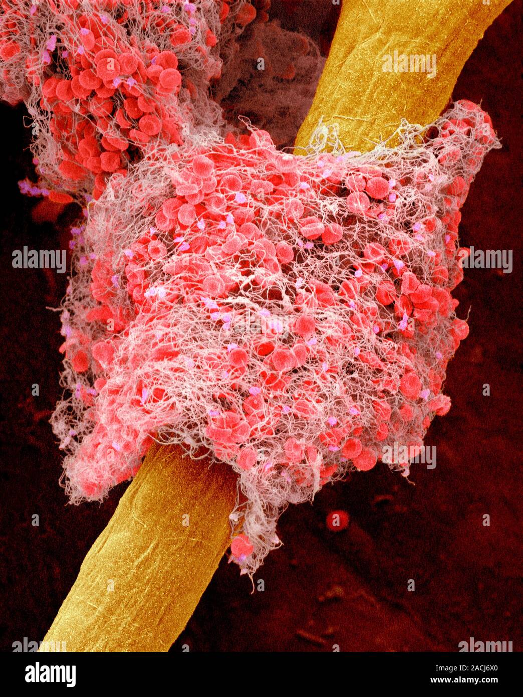 Blood clot. Coloured scanning electron micrograph (SEM) of a blood clot ...