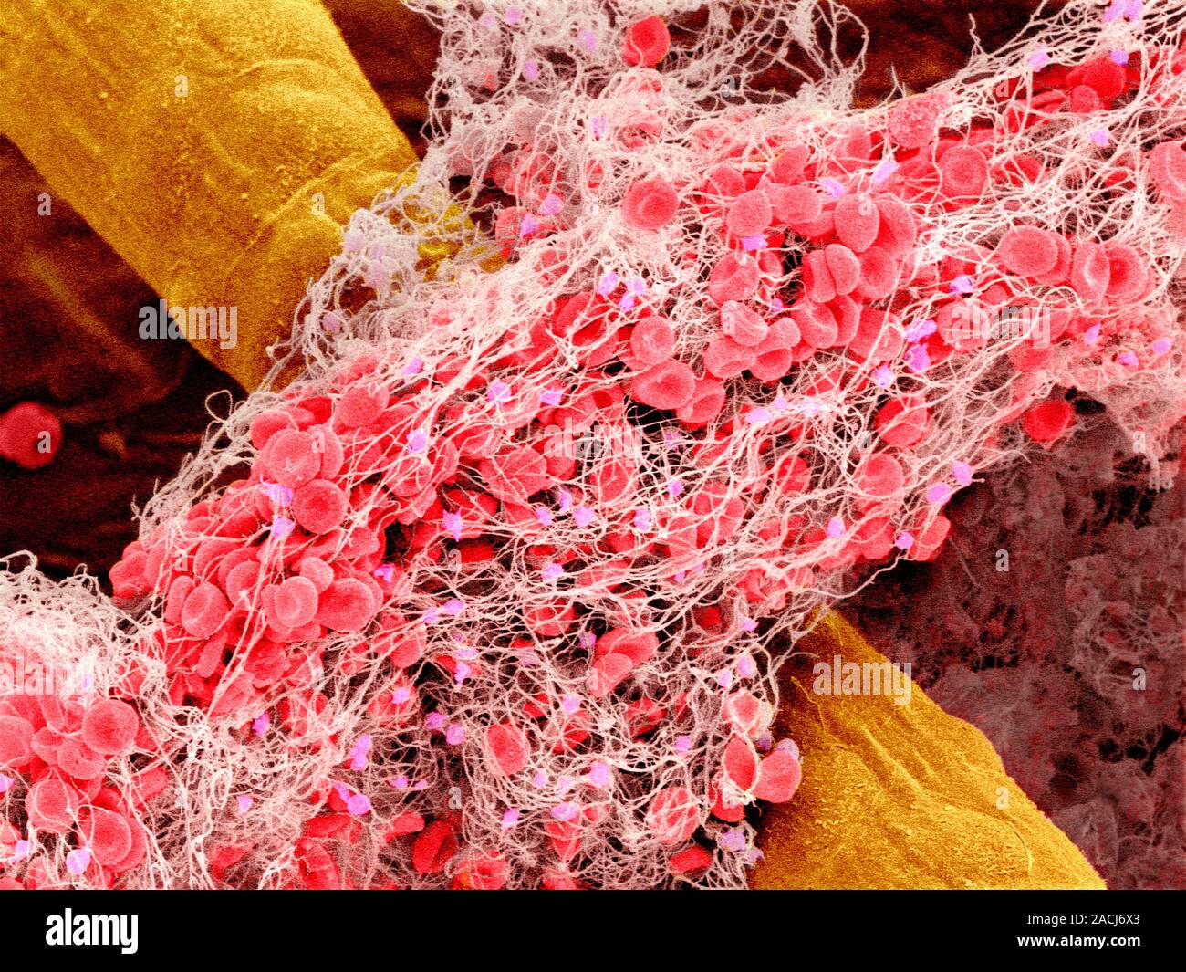 Blood clot. Coloured scanning electron micrograph (SEM) of a blood clot ...