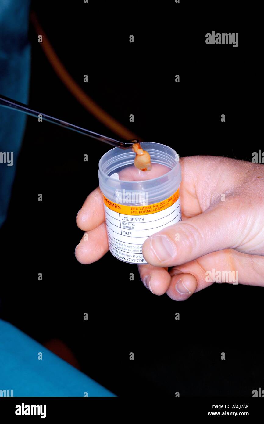 Excised nasal polyp being placed in a specimen jar. The polyp will be ...