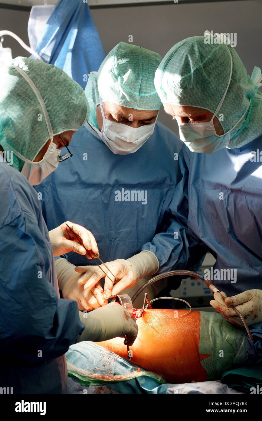 Hip replacement surgery. Surgeons performing a hip replacement ...