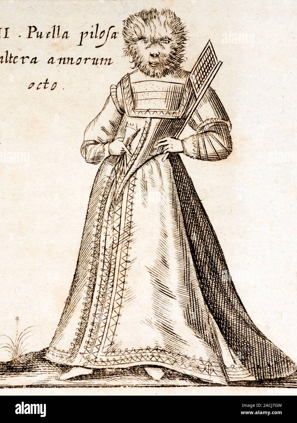 Hairy female daughter age 12'. Copperplate from Gaspar Schott's ...