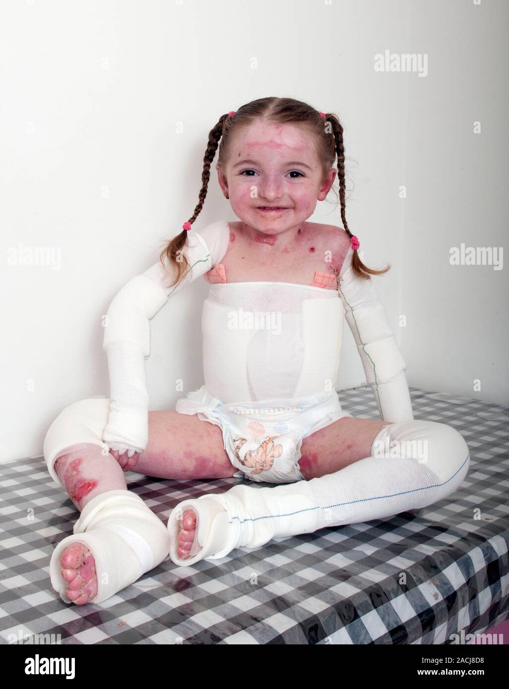 Genetic condition. Five-year old girl with recessive dystrophic ...