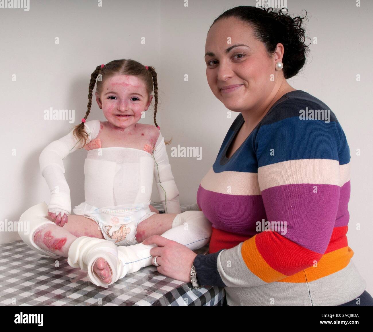 Genetic condition. Five-year old girl with recessive dystrophic ...