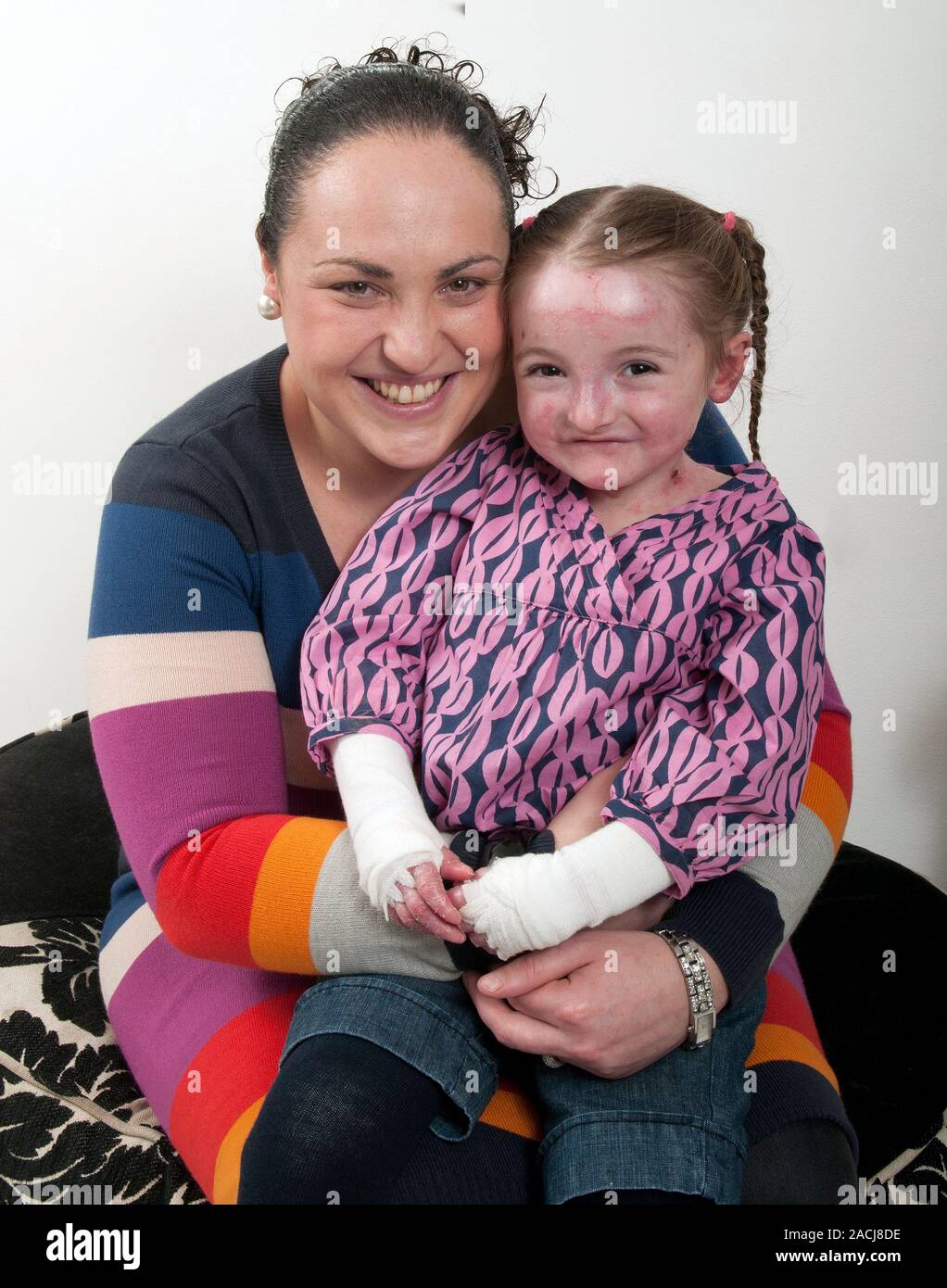 Genetic condition, Five-year old girl with recessive dystrophic ...