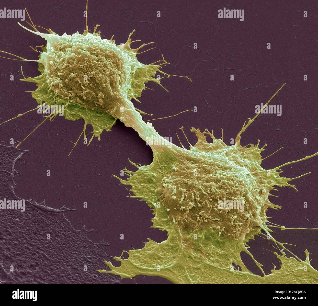 Dividing cancer cell. Coloured scanning electron micrograph (SEM) of a ...