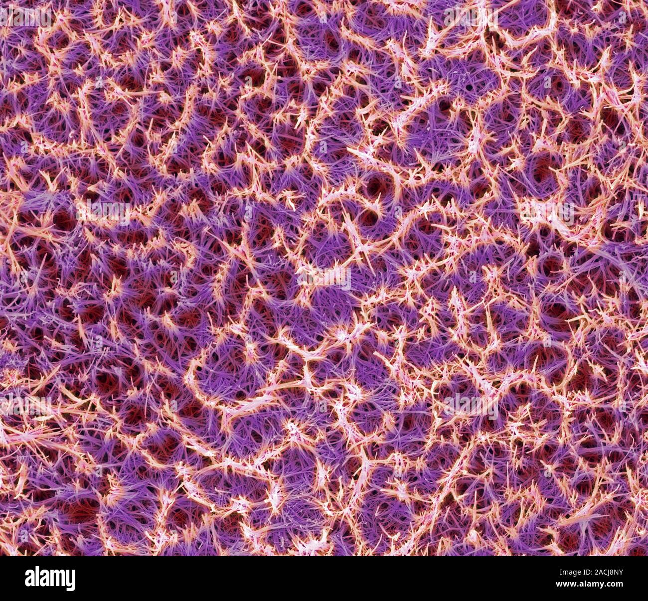 Kidney stone crystals, coloured scanning electron micrograph (SEM ...