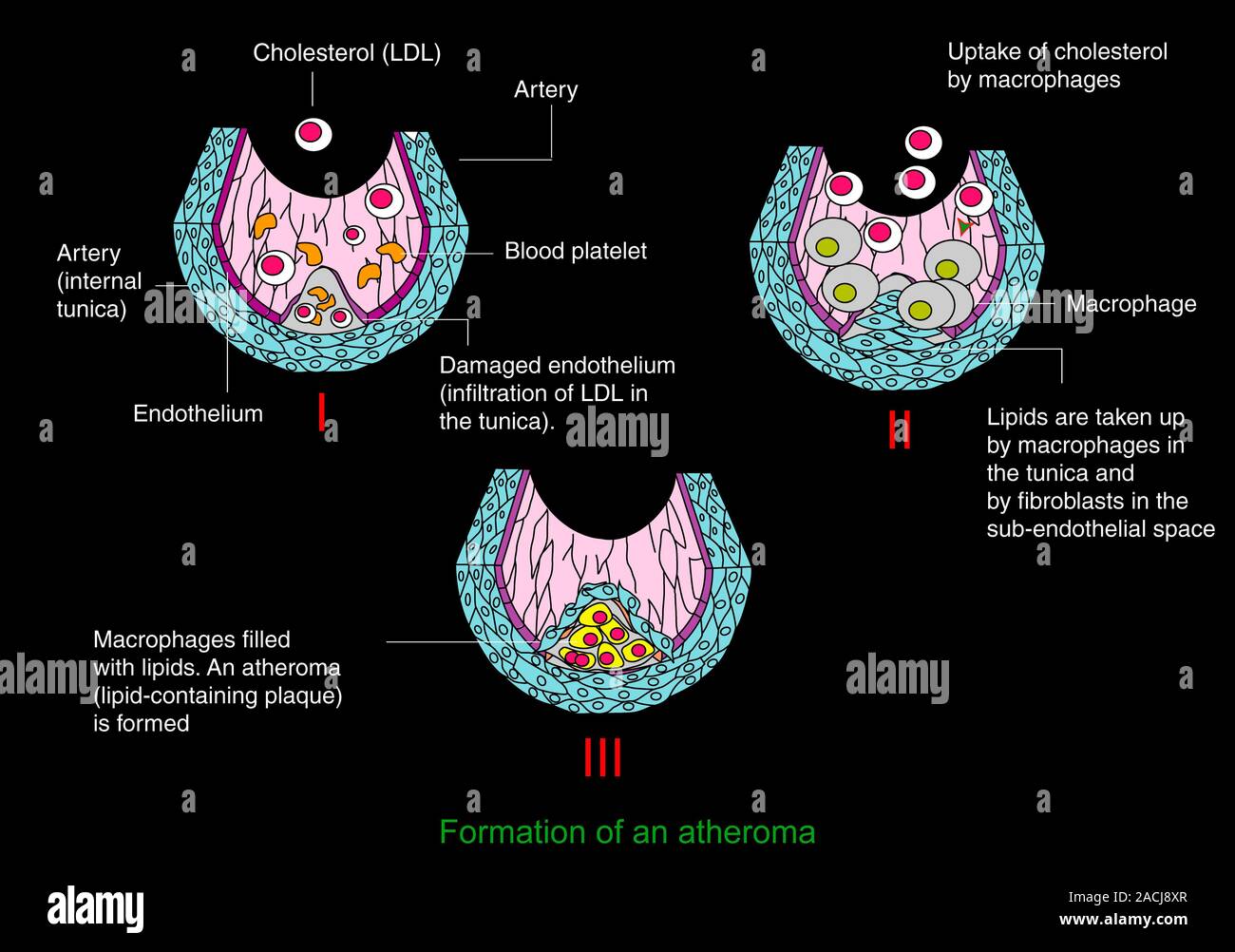 Atheroma formation. Diagram showing the stages in the formation of an ...
