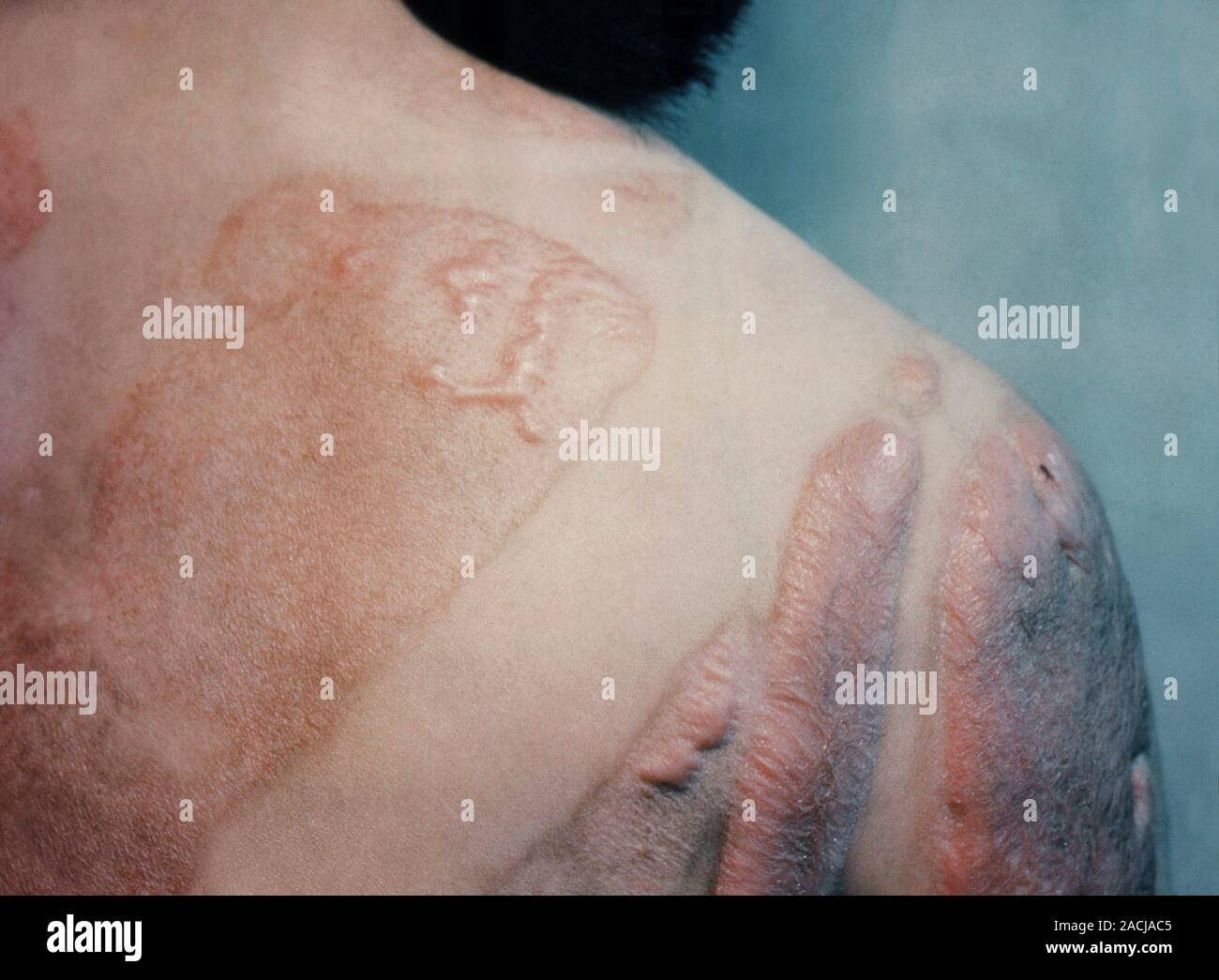 Radiation burn scar tissue, Hiroshima. Close-up of keloids (darker ...