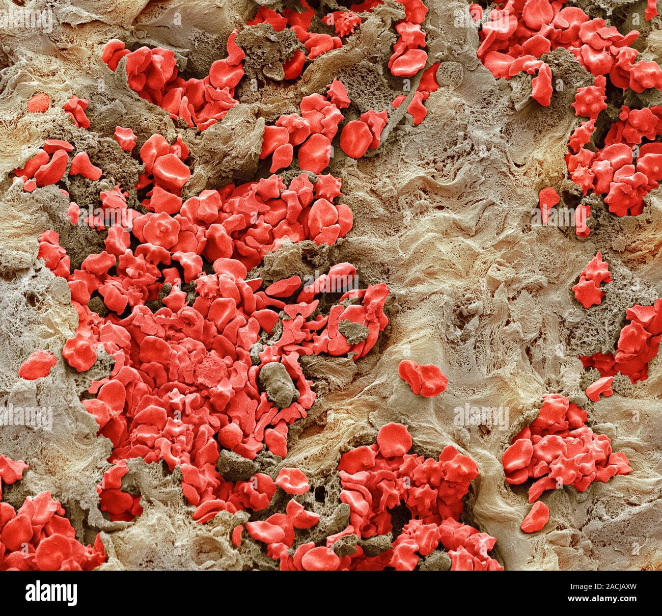 Tumour filled with blood. Coloured scanning electron micrograph (SEM ...