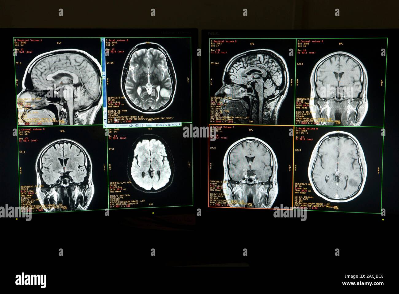 Brain CT scanning. Computed tomography (CT) scans of a patient's brain, as displayed on a screen ...