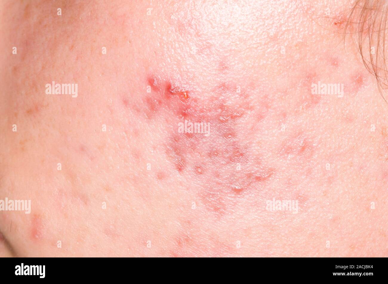 Close-up of the skin of the cheek in a 17 year old male patient showing ...