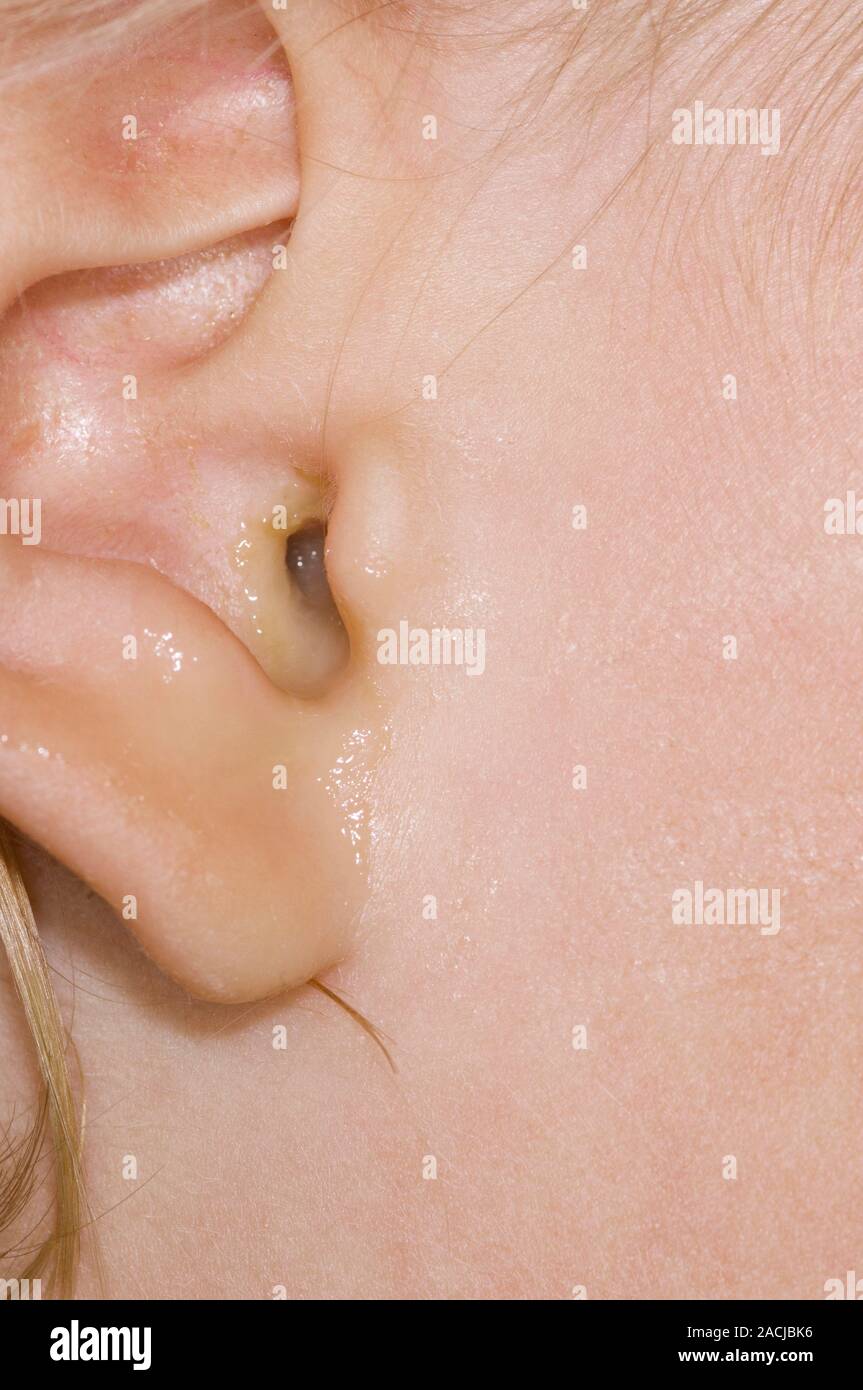 Close-up of the ear in a 2 year old male patient showing melted wax ...
