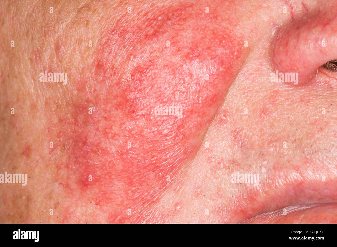 Allergic skin reaction to the drug cetuximab on the face in a 77 year ...