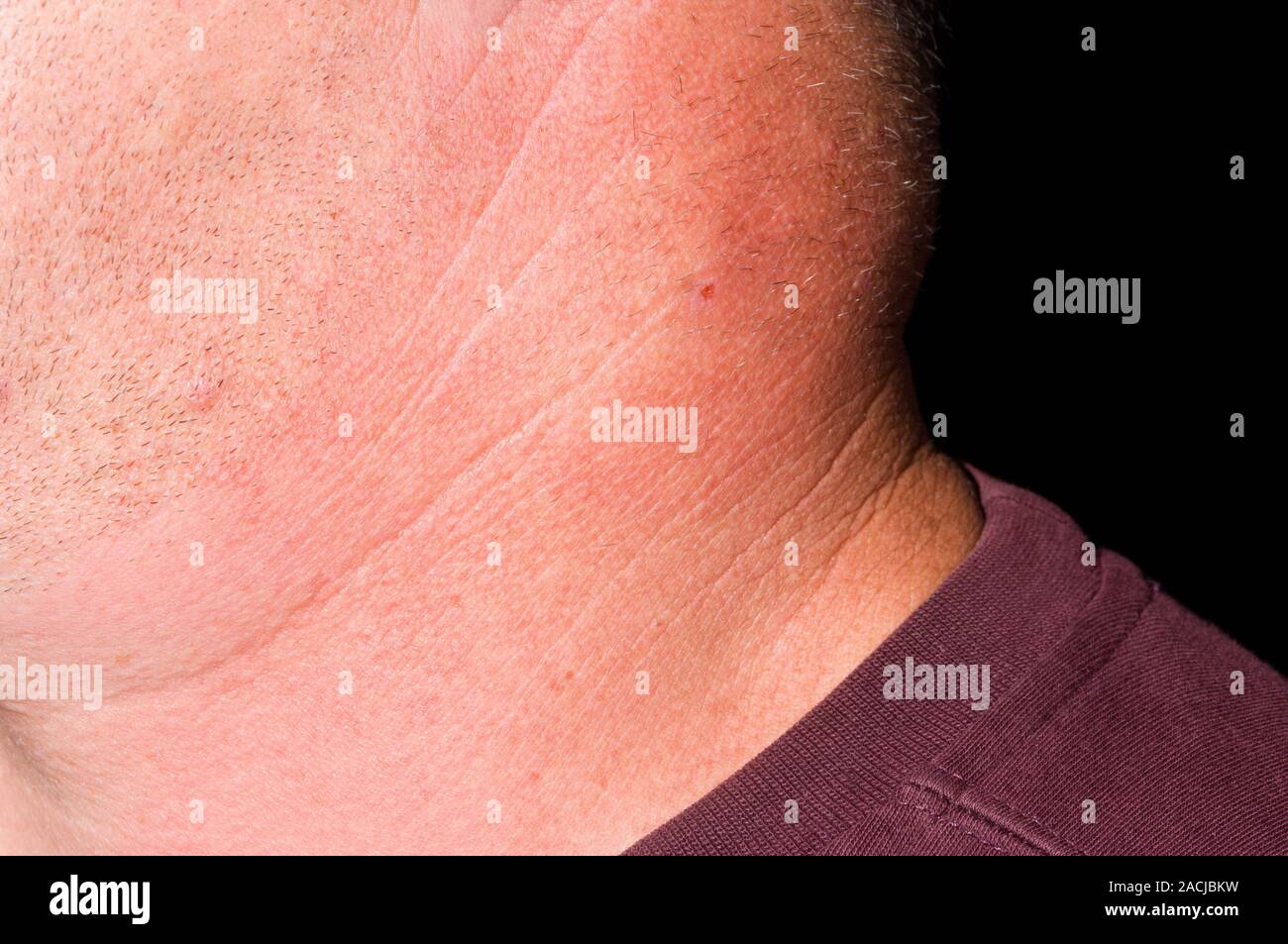 Red and inflamed neck in a 51 year old male patient after a wasp sting ...