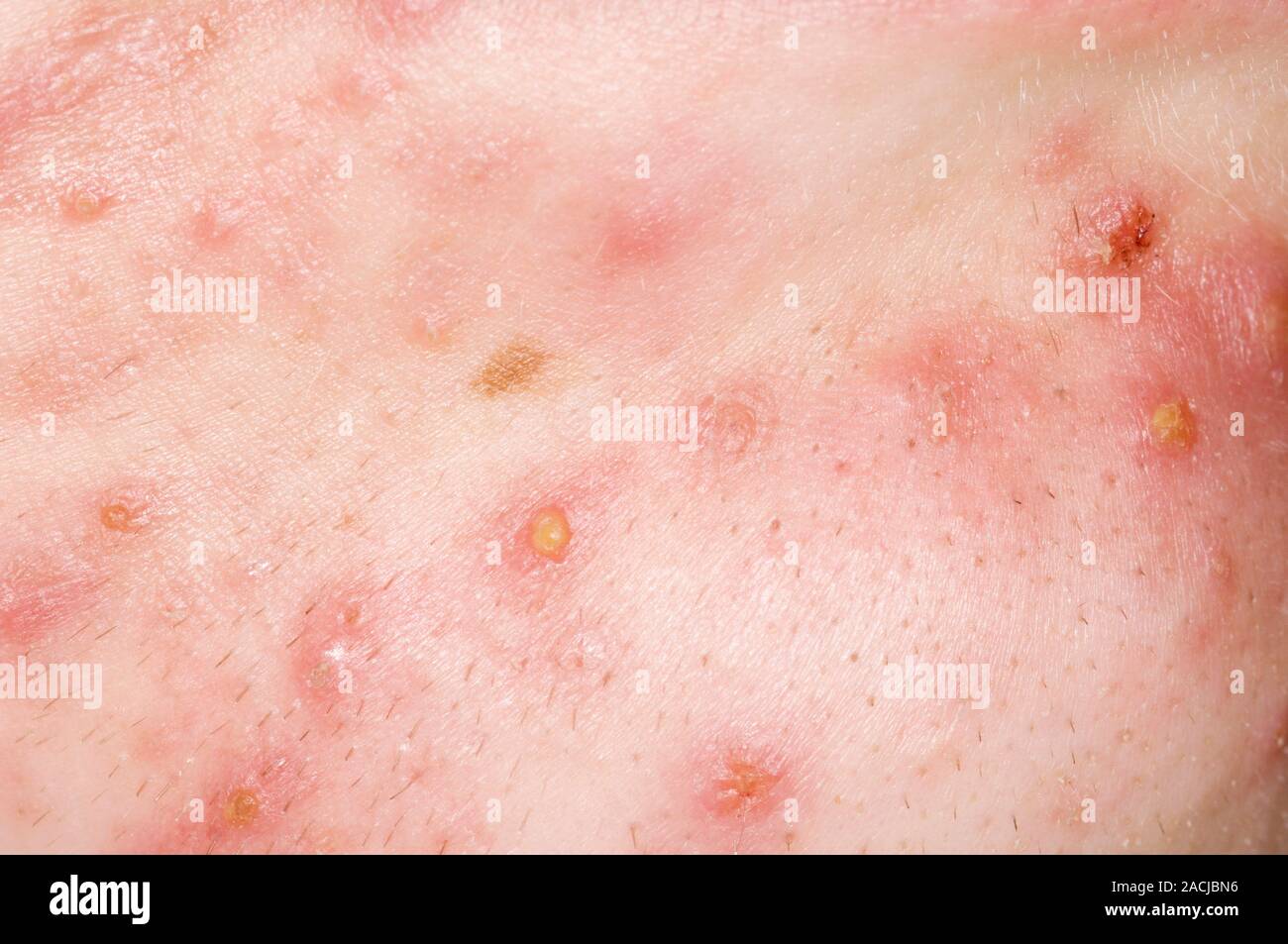 Close-up of the skin of the cheek in a 15 year old male patient showing ...