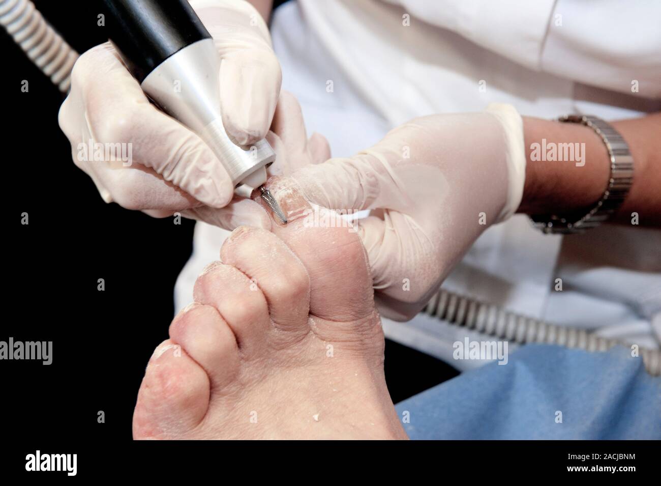 Podiatry treatment of the foot. Debridement tool being used to remove a ...