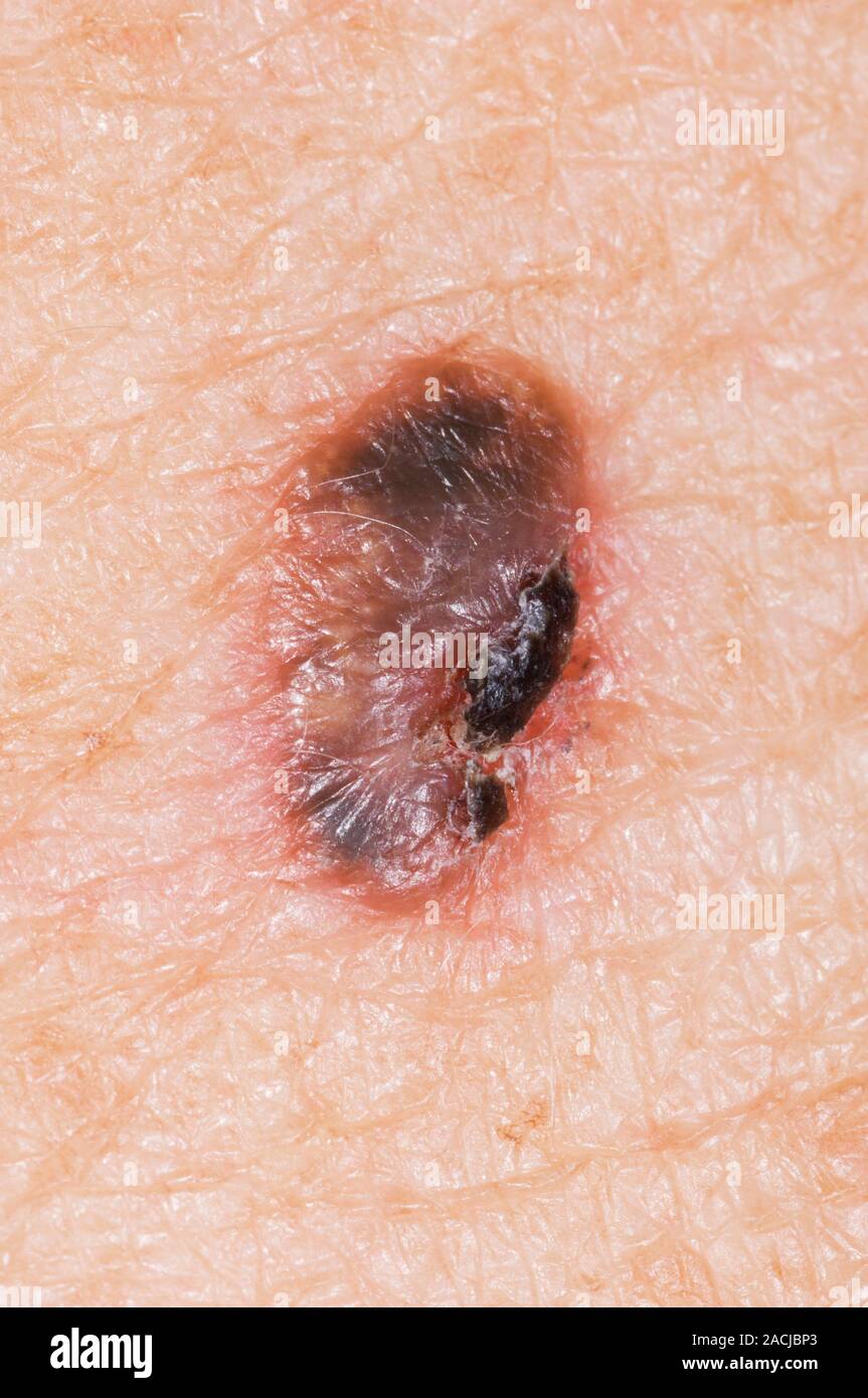 Close-up of a traumatised seborrhoeic wart (keratosis) on the skin in a ...