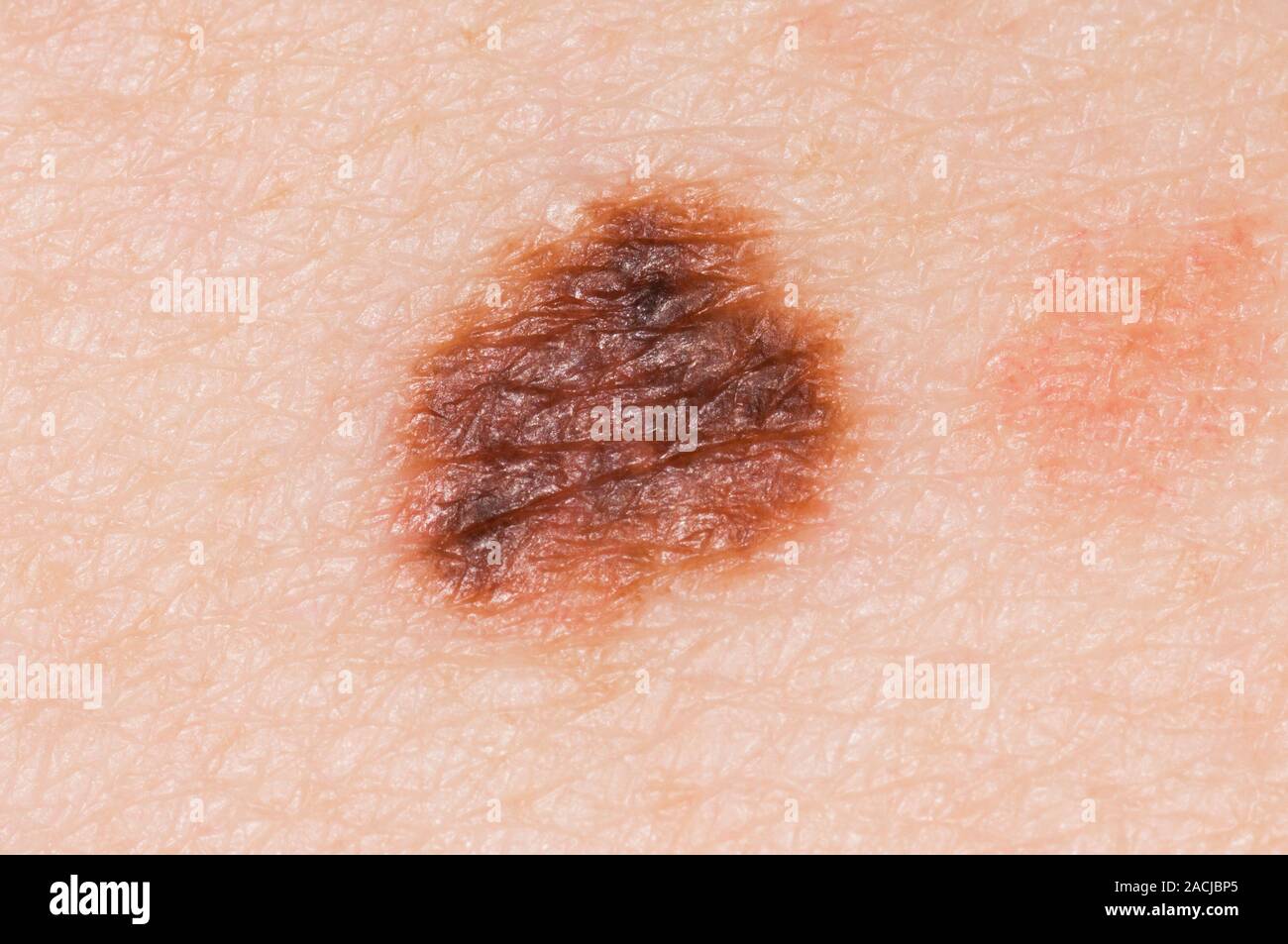 Close-up of an atypical naevus (mole) with spitzoid features on the ...