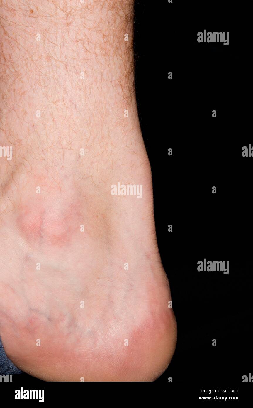 Swollen achilles tendon (achilles tendinitis) in the ankle of a 37 year ...