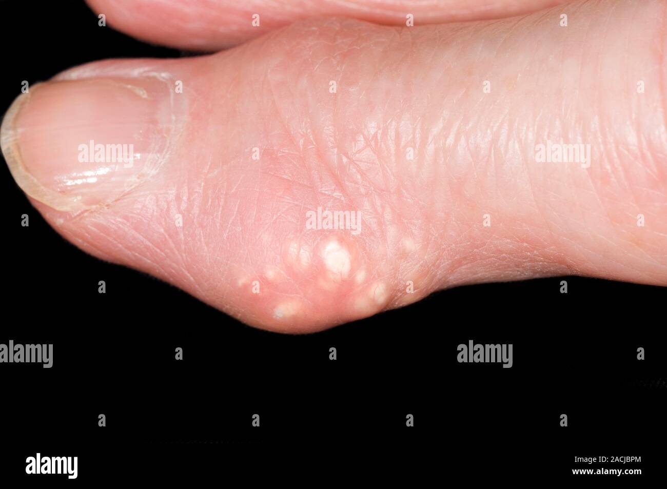 Gout tophus on the finger in an 90 year old female patient. Gout is a ...