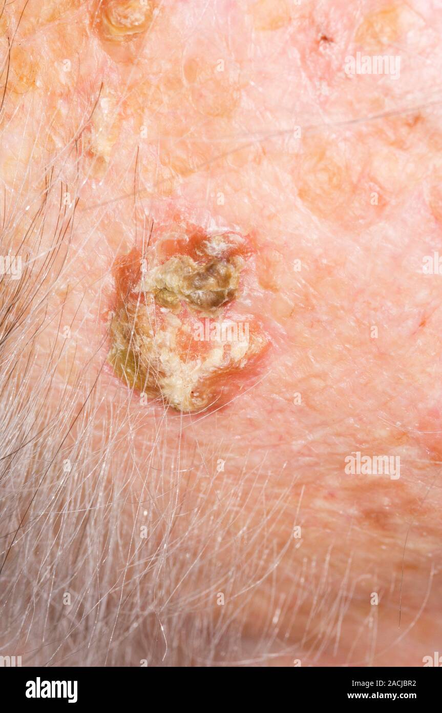 Close Up Of A Bowenoid Keratosis On The Scalp In An 88 Year Old Male Patient A Bowenoid