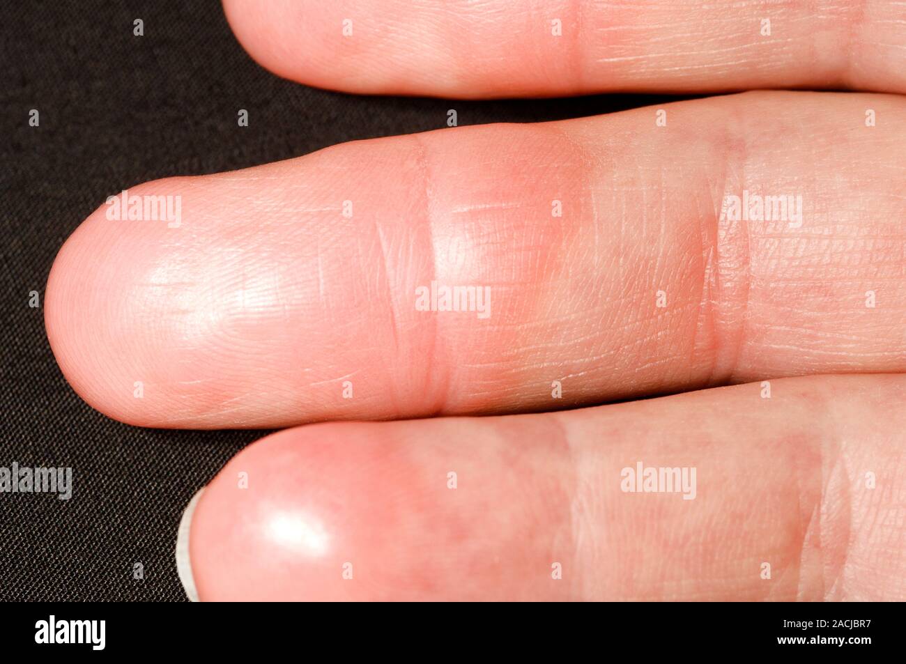 Close-up of discoloured fingers (paraneoplastic phenomenon) in a 67 ...