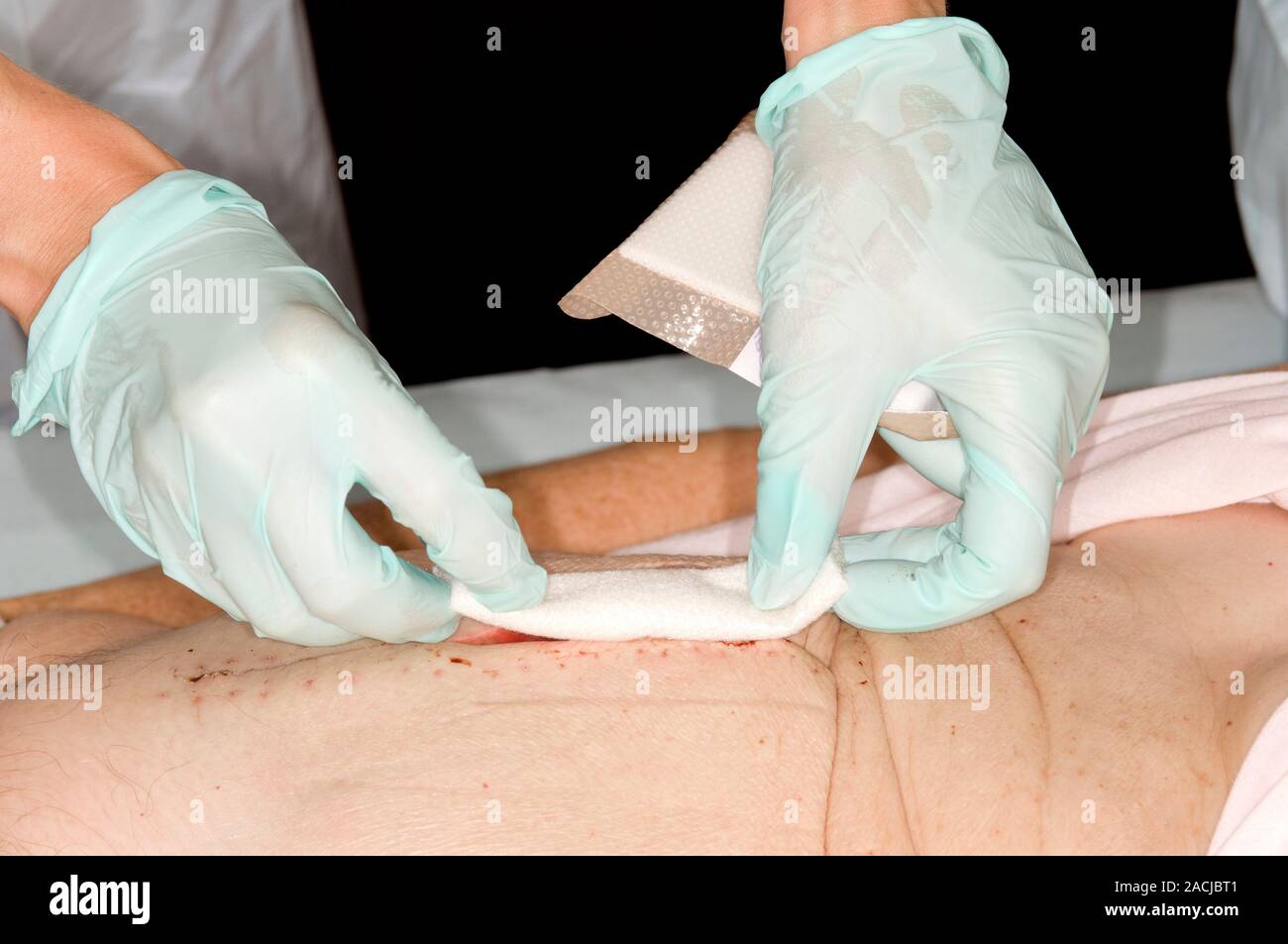 Gloved hands apply a new gauze dressing over a dehisced (opened ...