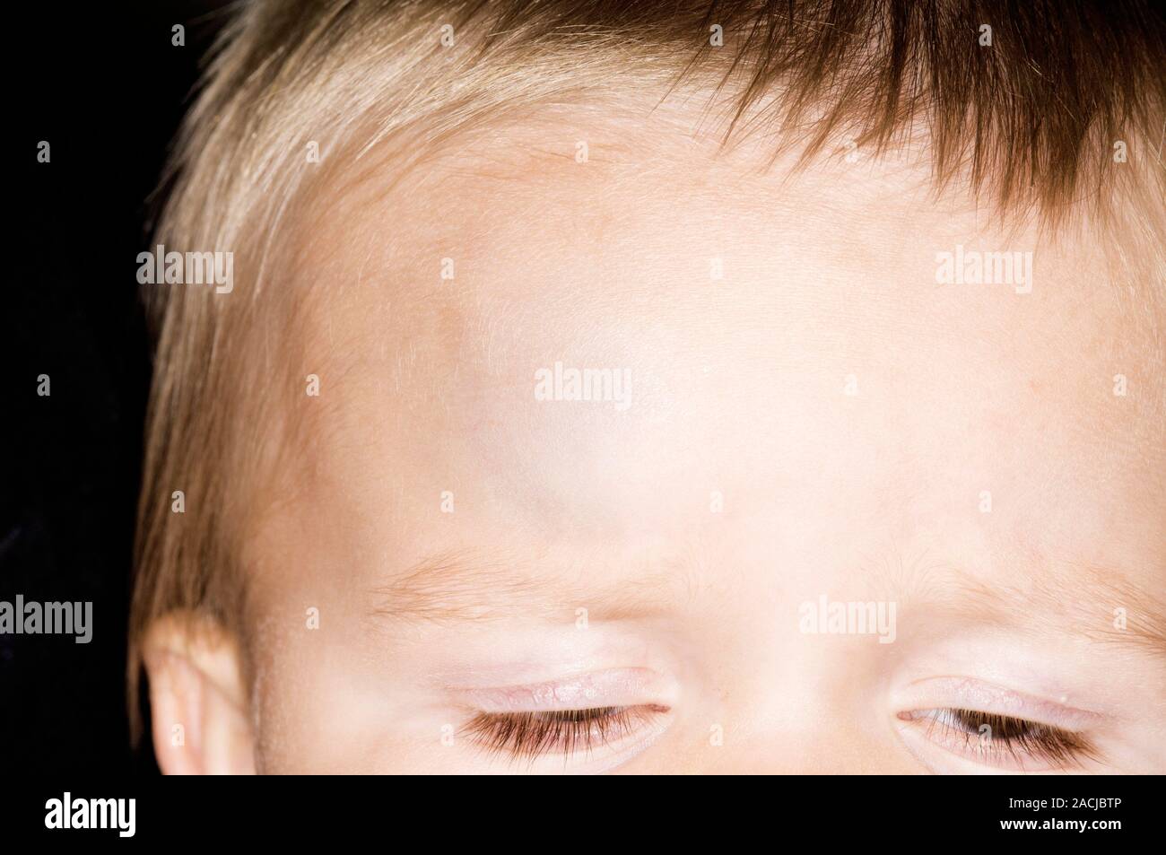 Bump on the forehead in a 1 year old male patient, a common childhood ...