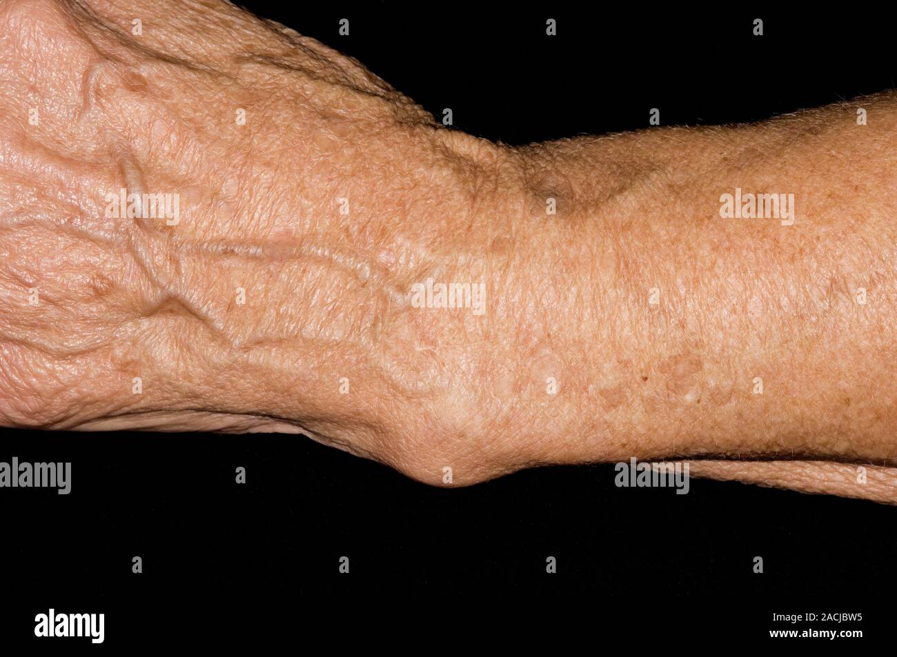 Deformed wrist after a previous fracture of the radius and ulna bones ...