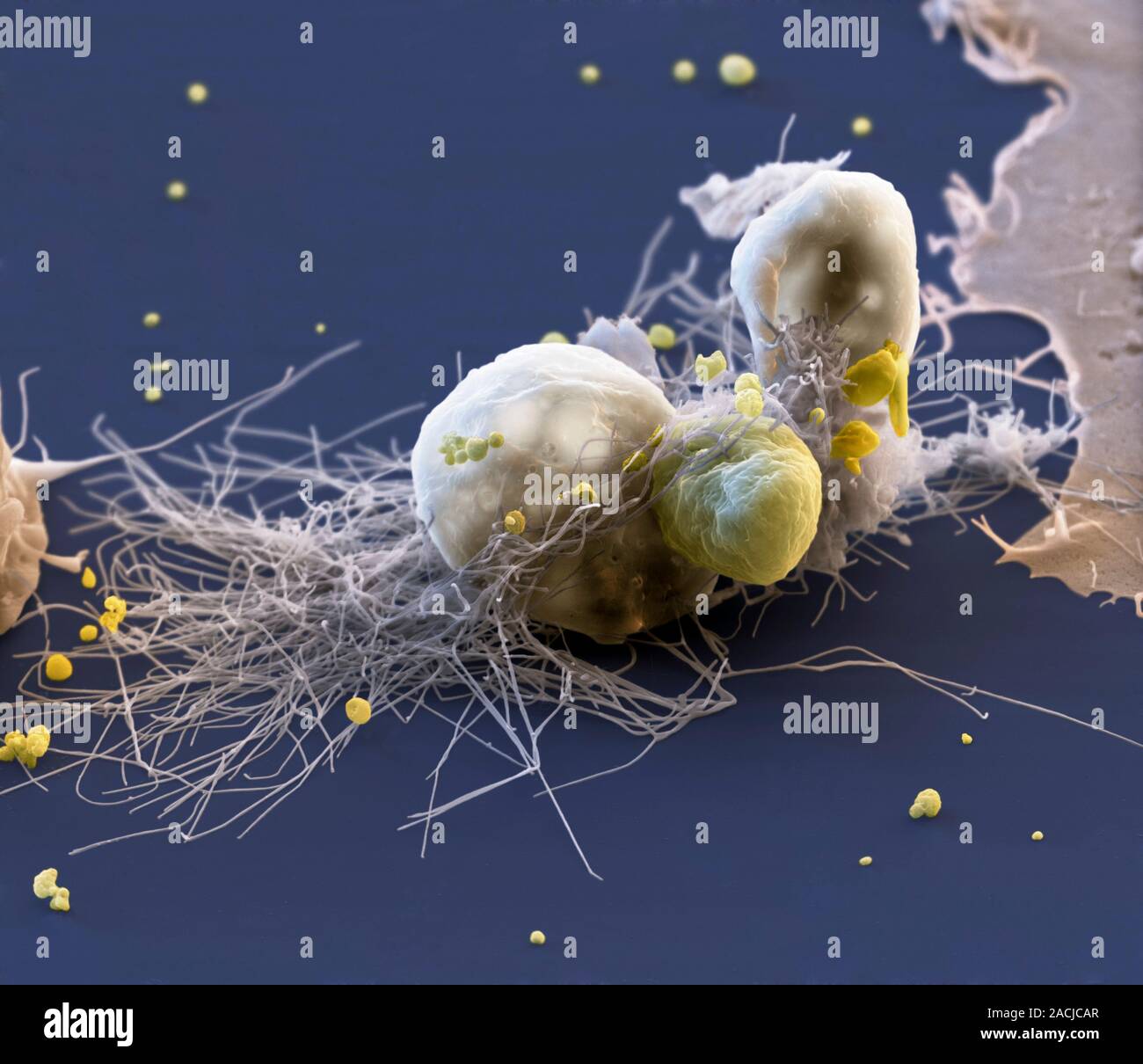 Apoptosis. Coloured scanning electron micrograph (SEM) of a cell ...